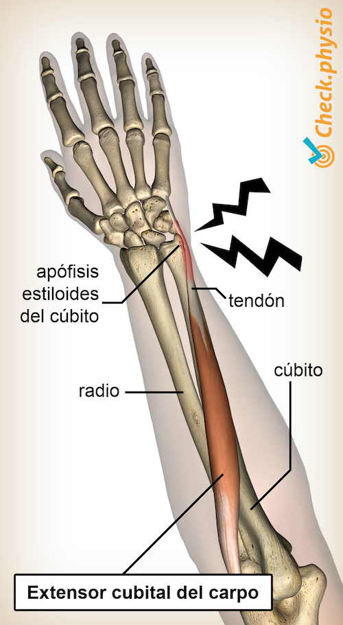 Tendinopat a Del Extensor Cubital Del Carpo Physio Check