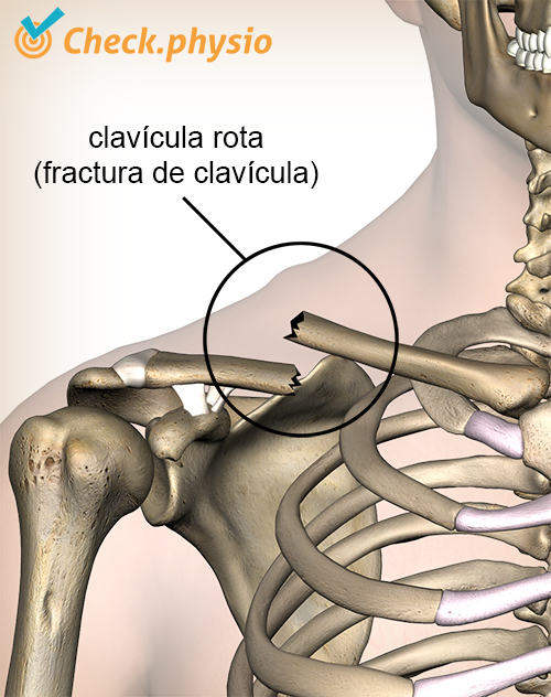 Fractura de clavícula | Causa, síntomas y tratamiento